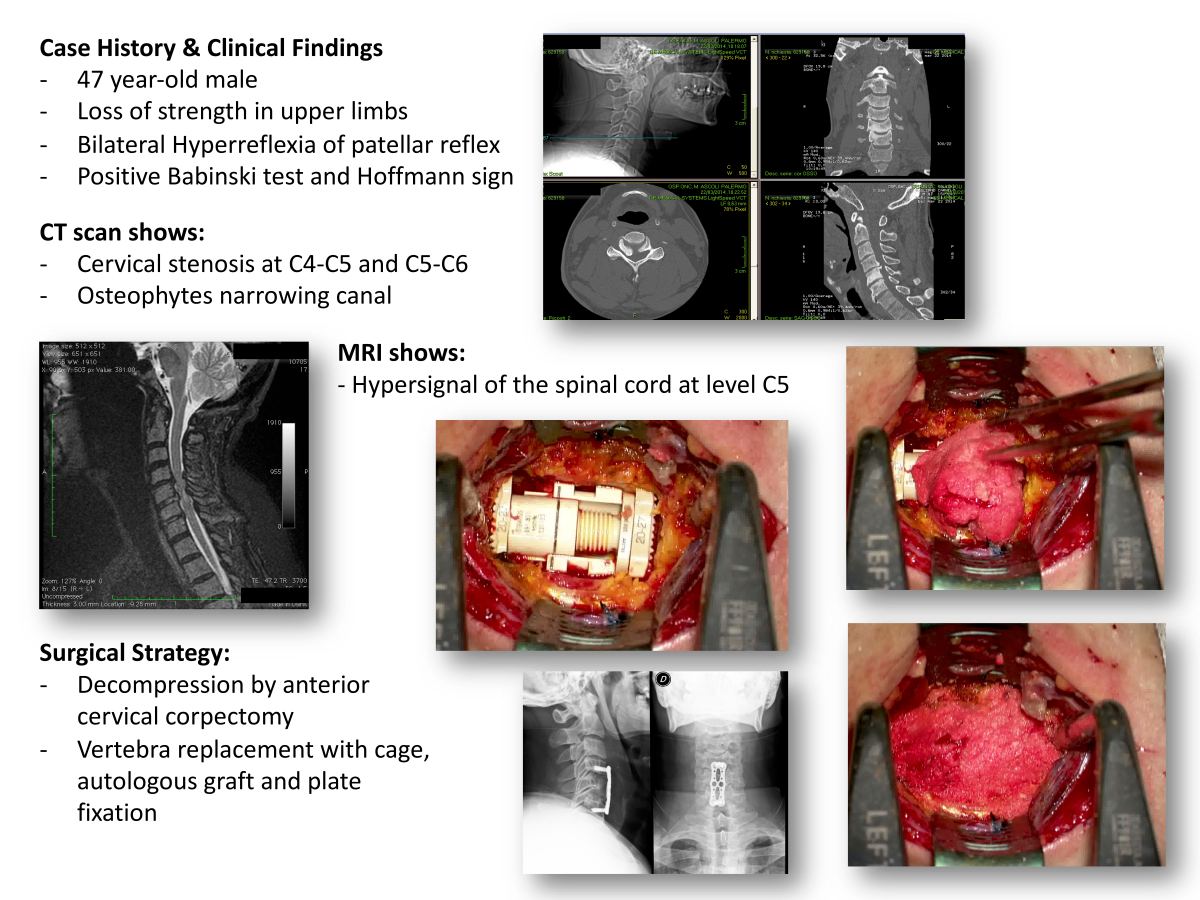 Anterior Corpectomy and Fusion for Cervical Spondylotic Myelopathy ...